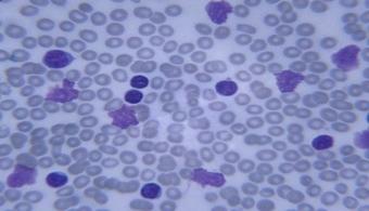 ungen-que-previene-y-potencia-el-cancer- (340×195)